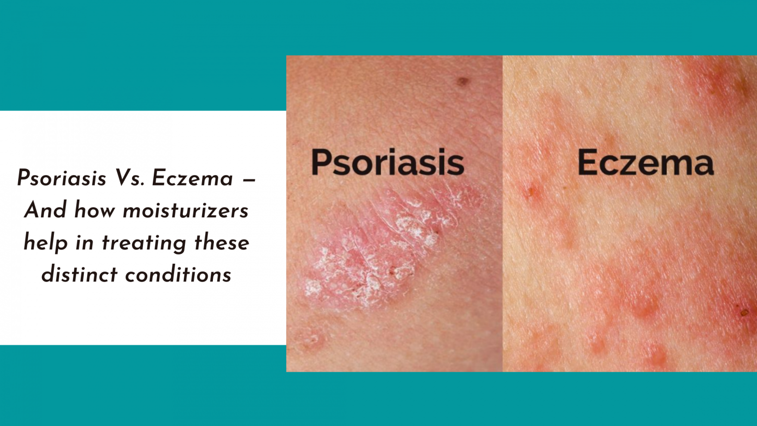 Psoriasis Vs. Eczema — And how moisturizers help in treating these ...
