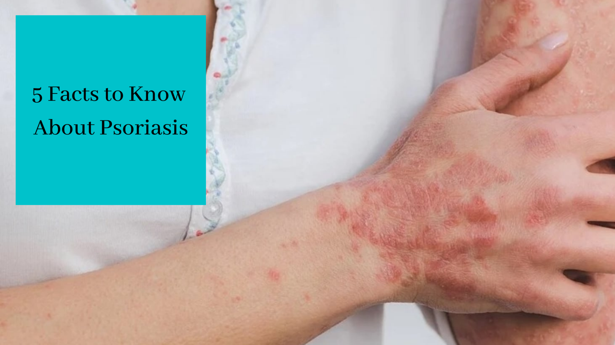 5 Facts to Know About Psoriasis