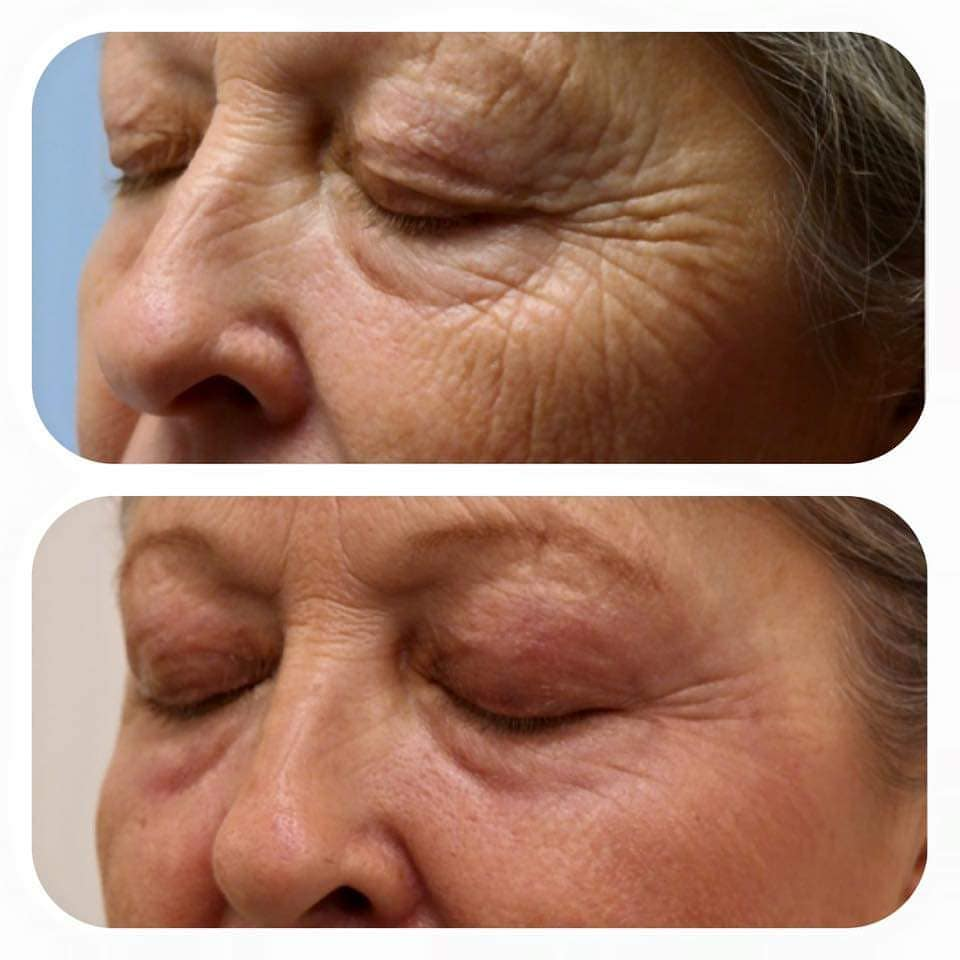 PLEXR PLUS Plasma Technology- A New Age Non-Invasive Cosmetic Skin ...