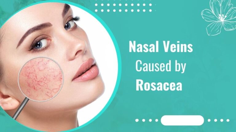 Nasal Veins Caused by Rosacea