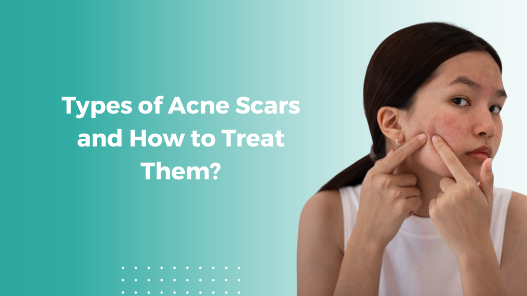 Types of Acne Scars and How to Treat Them? - Dr E Dermatology